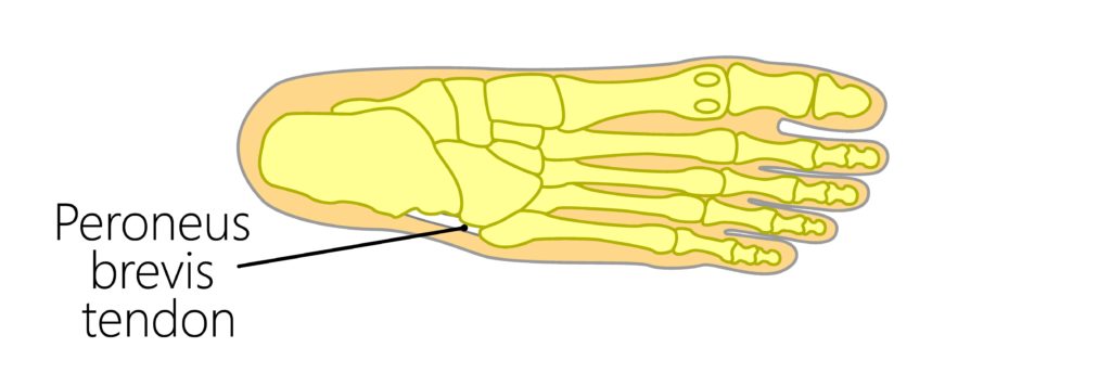 Peroneus Brevis Tears & Tendonitis [FIX Peroneus Brevis Tendon Pain!]