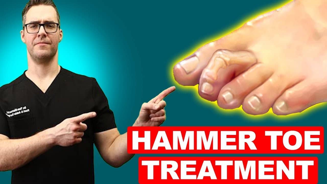 Second Toe Pain due to a Hammer Toe #1 Best Treatment