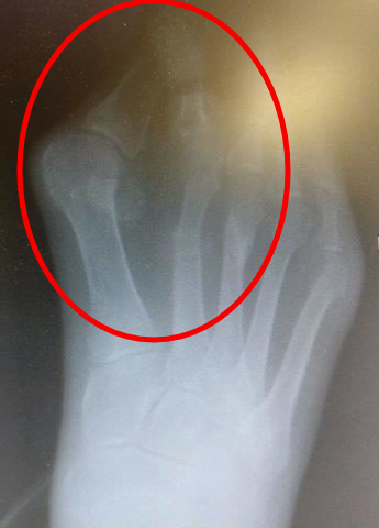 Pain in the 2nd Toe While Walking [Causes, Symptoms & Best Treatment]