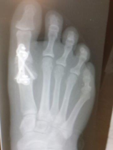 7 Strong Causes of Foot Pain Behind Big Toe & Best Remedies