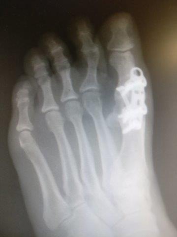 Great Toe Joint Fusion Surgery [Faster Recovery Time Tips!]