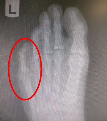 Sprained Little Toe [How to Tell If Broken & Best Treatment]