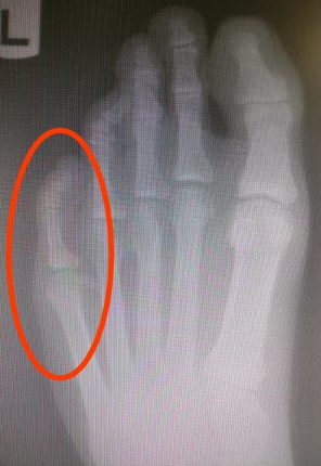 Pinky Toe Pain - 7 Causes, Symptoms & Best Home Treatment