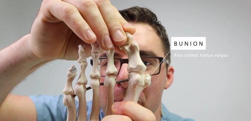 What Is A Bunion? - Causes, Symptoms & 3 Best Treatment