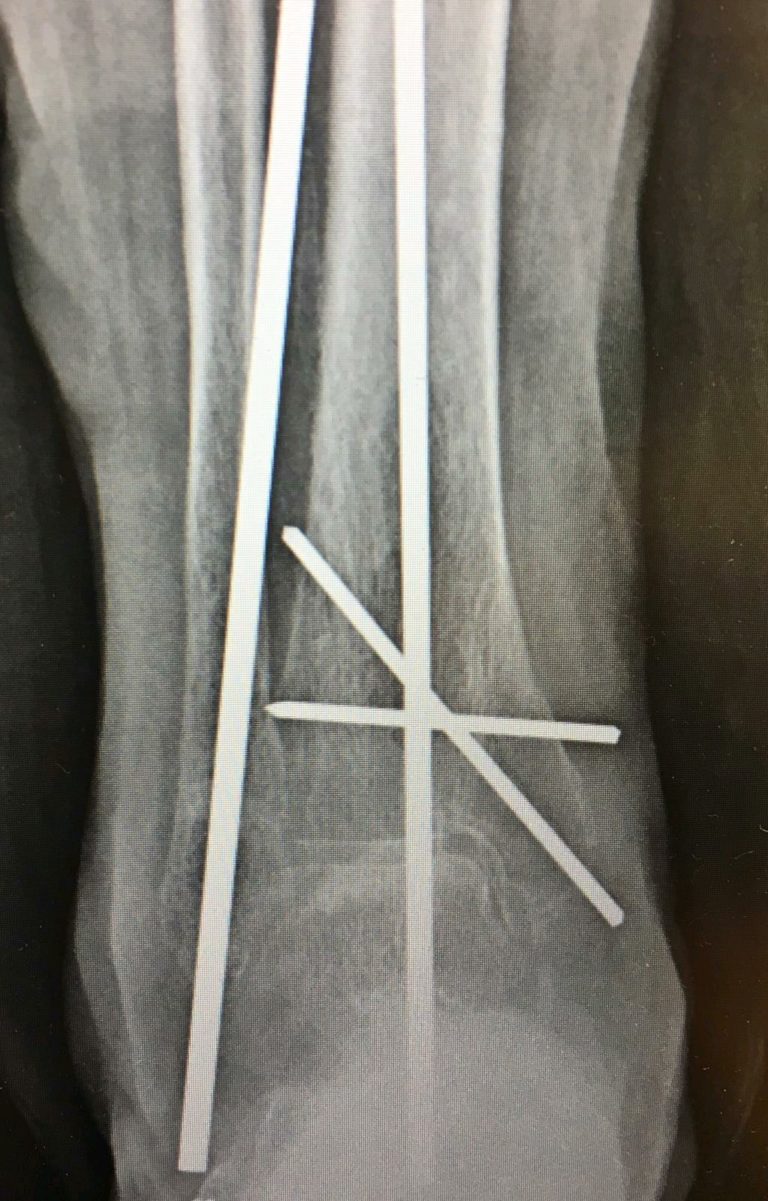 Chipped Shin Bone: Make 100% sure it's not broken!