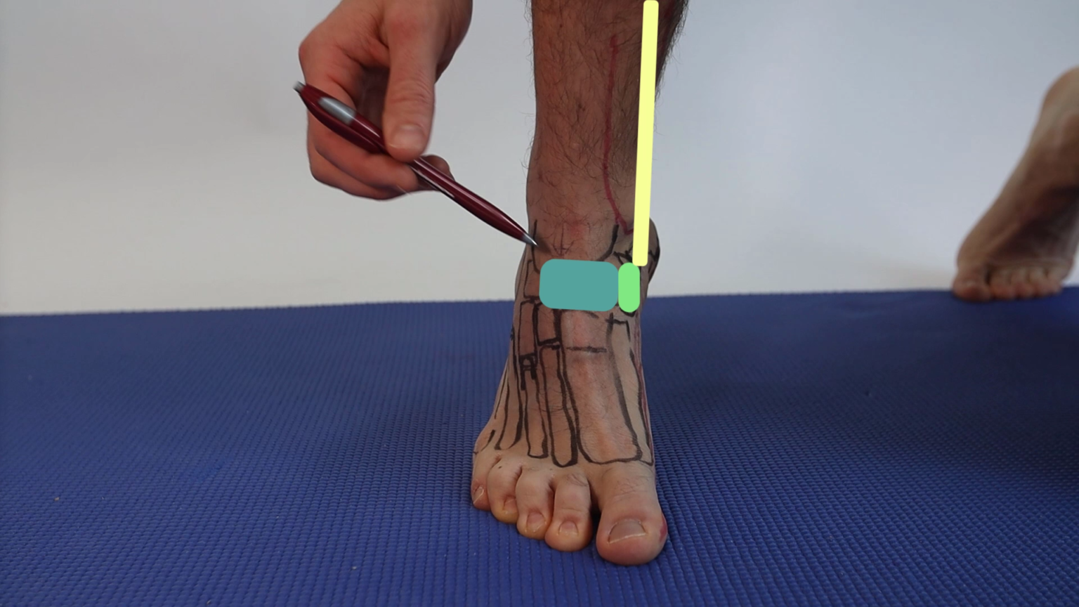 Navicular Fracture Treatment [Top of Foot Stress Fracture]
