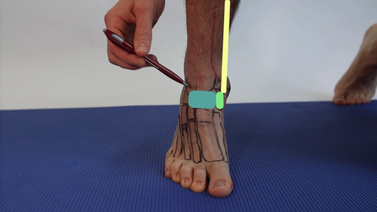 Navicular Fracture Treatment [Top of Foot Stress Fracture]