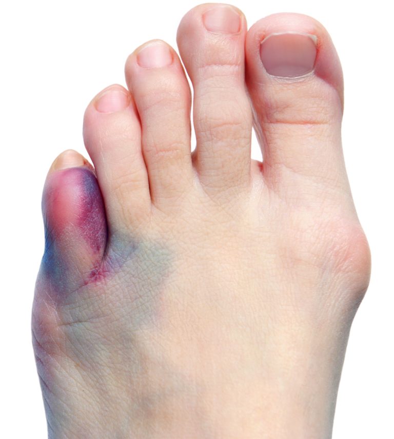 Sharp Pain in the Pinky Toe [Causes, Symptoms & Best Treatment]