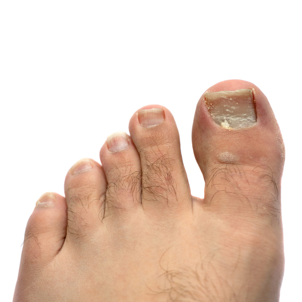 Toenail Falling Off: The #1 Best SECRET Podiatrist Tips