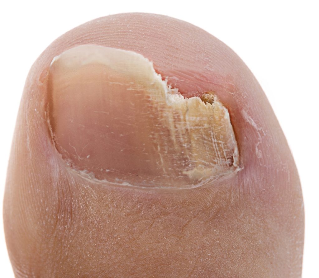 Toenail Fungus Onychomycosis #2 - Balance Foot & Ankle Specialists