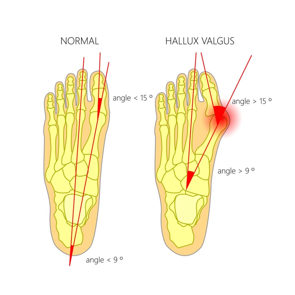 Dislocated Big Toe | 5 Causes, Symptoms & Best Treatment