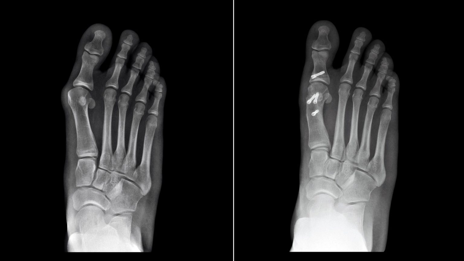 Hallux Varus Surgery | Michigan Podiatrist