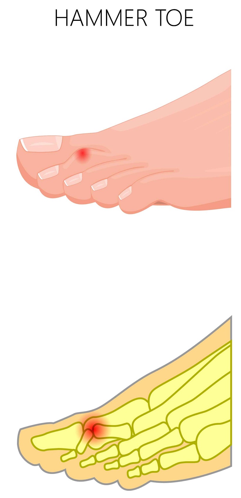 Second Toe Pain due to a Hammer Toe #1 Best Treatment
