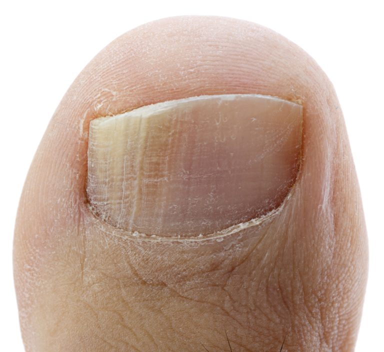 Toenail Fungus Onychomycosis #3 - Balance Foot & Ankle Specialists
