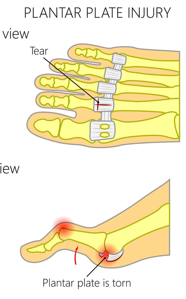 Plantar Plate Injury & Plantar Plate Tear Treatment [Repair & More]