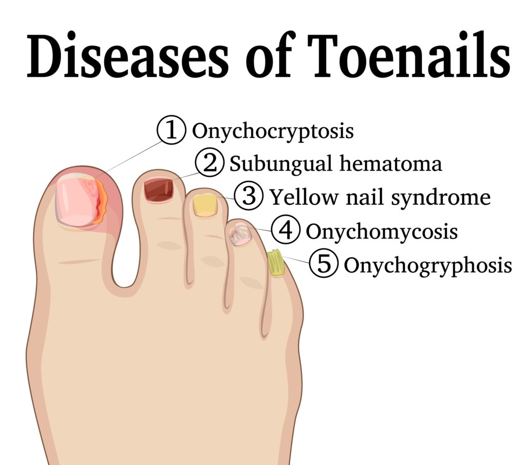 Toenail Diseases Ingrown toenail, hematoma, yellow toenail ...