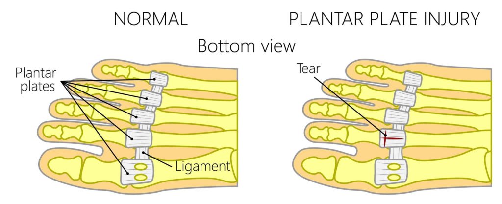 2nd Toe Capsulitis, Claw Toe & Hammer Toe RELIEF [Taping & Treatment]