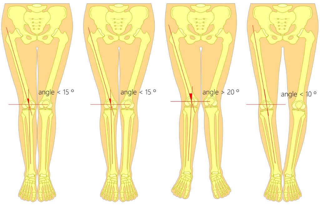 Leg Length Discrepancy Best Treatment Exercises Shoes Heel Lifts 