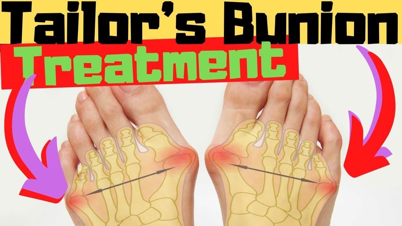 Pinky Toe Bunion (Tailor’s Bunion) #1 Best Causes,Treatment