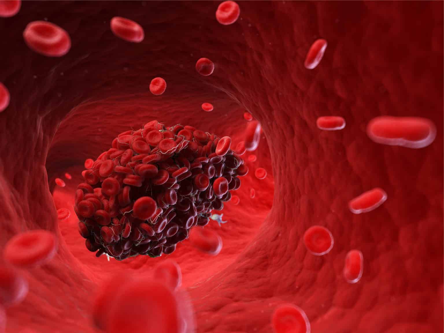 Blood Clot in Leg: 7 Best Signs, Causes & Treatment
