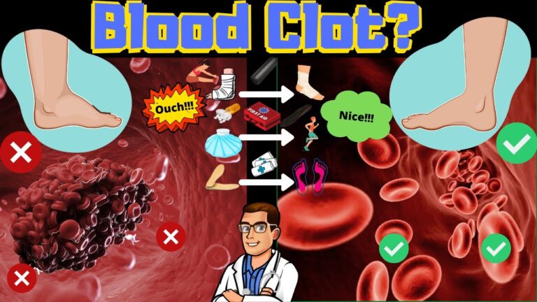 Blood Clot Symptoms & Signs [Causes & Treatment of Leg blood clots]