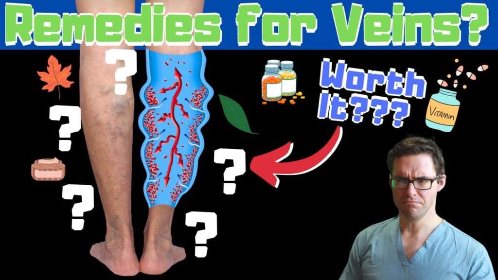 #1 Rated Varicose Vein Home Remedies [Spider Veins in Legs Treatment]