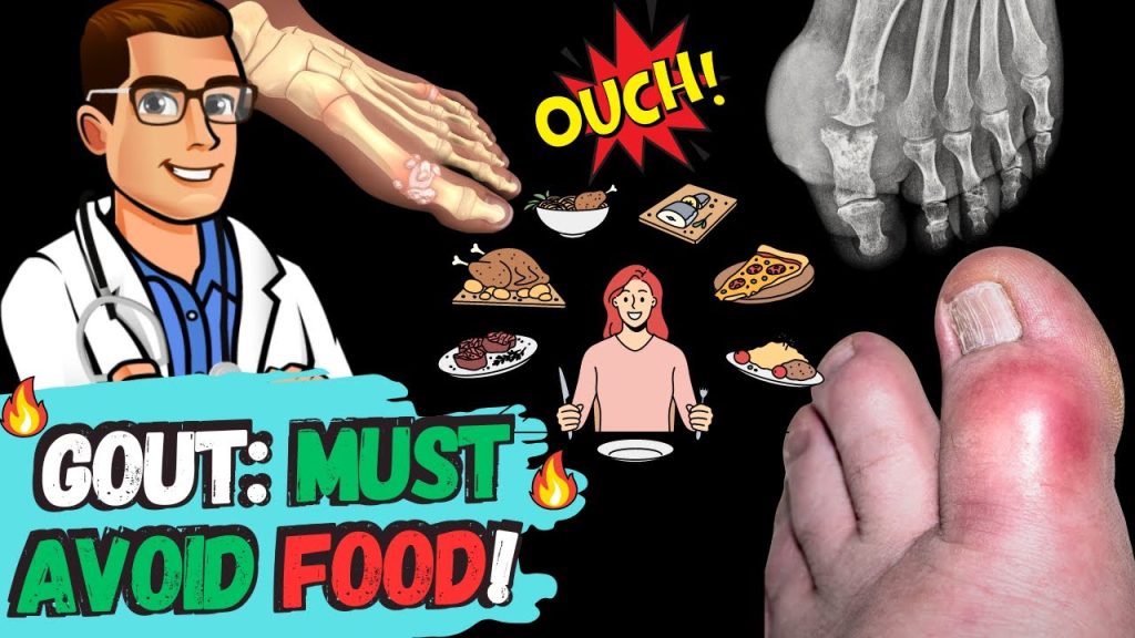 🔥best Gout Diet And Foods To Avoid🔥 Uric Acid Foods That Cause Gout