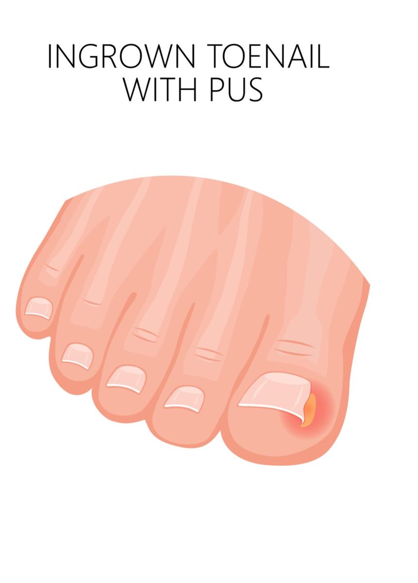 White Patches On Toenails Causes Signs And Best Treatment