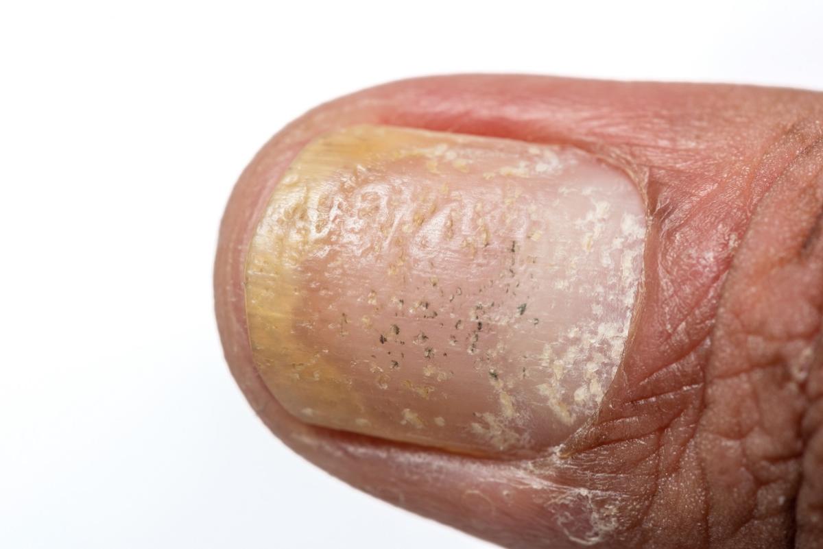 White Spots On Toenails After Removing Nail Polish